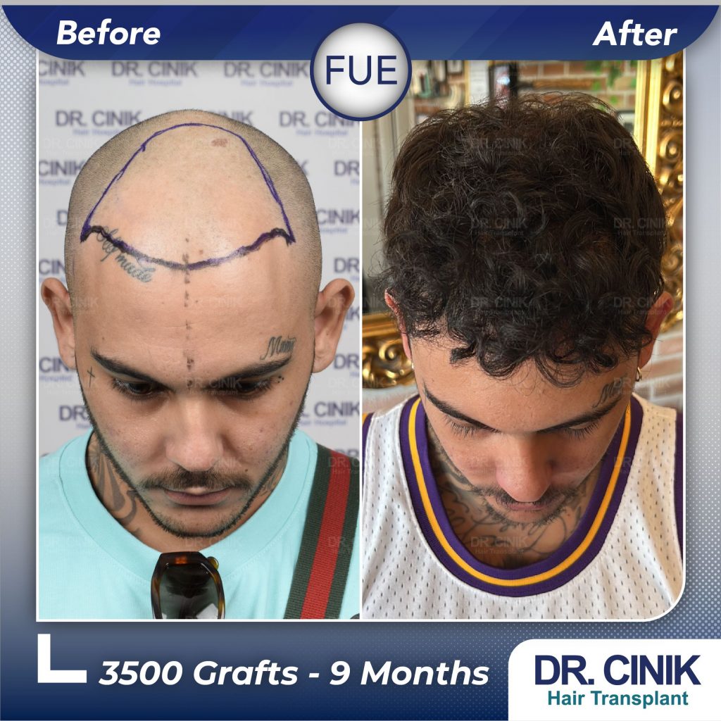 Dr. Cinik Hair Hospital - opinions - CheveuxVital - Blog capillaire